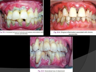 Chronic periodontitis | PPTX