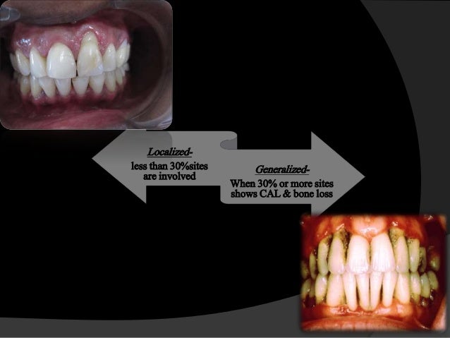 Chronic periodontitis