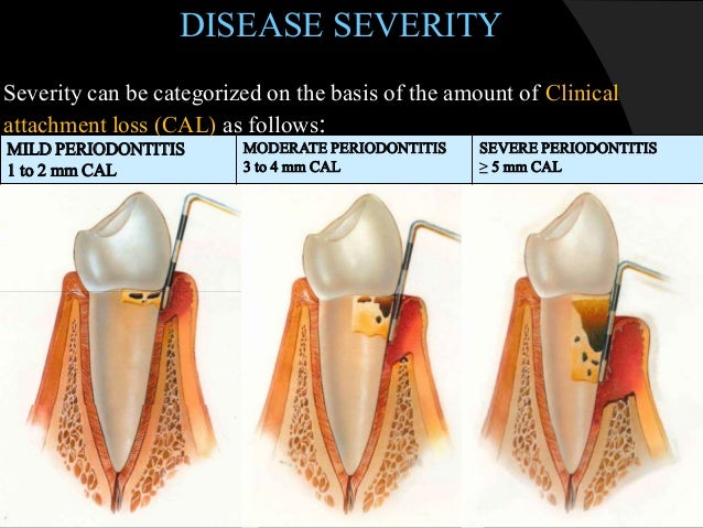 Chronic periodontitis