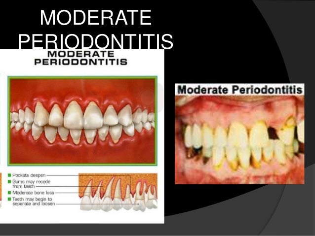 Moderate Periodontal Disease