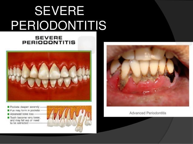Chronic periodontitis