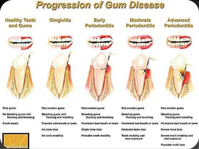 Chronic periodontitis