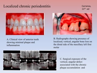 Chronic periodontitis | PPTX