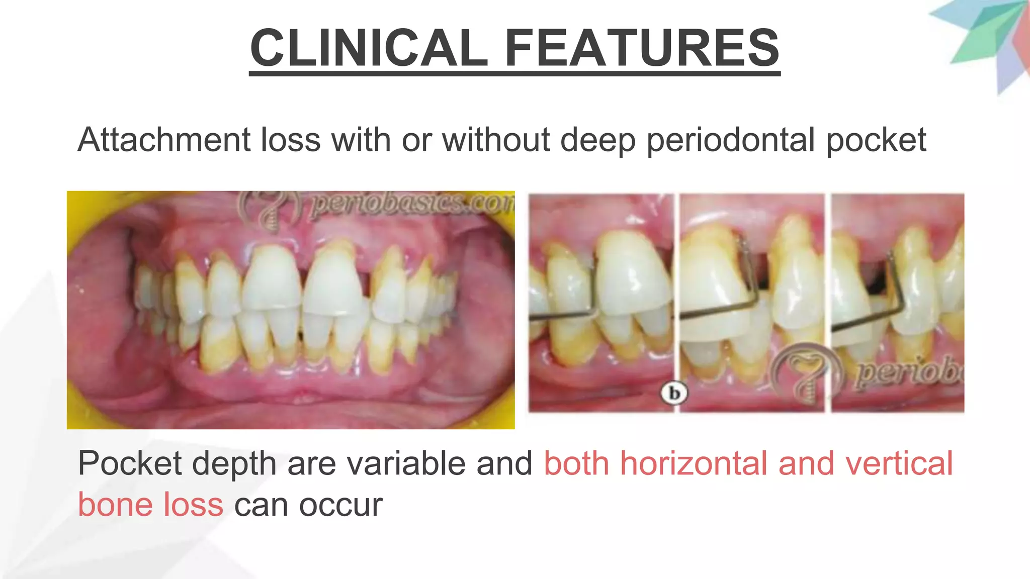Chronic periodontitis | PPTX