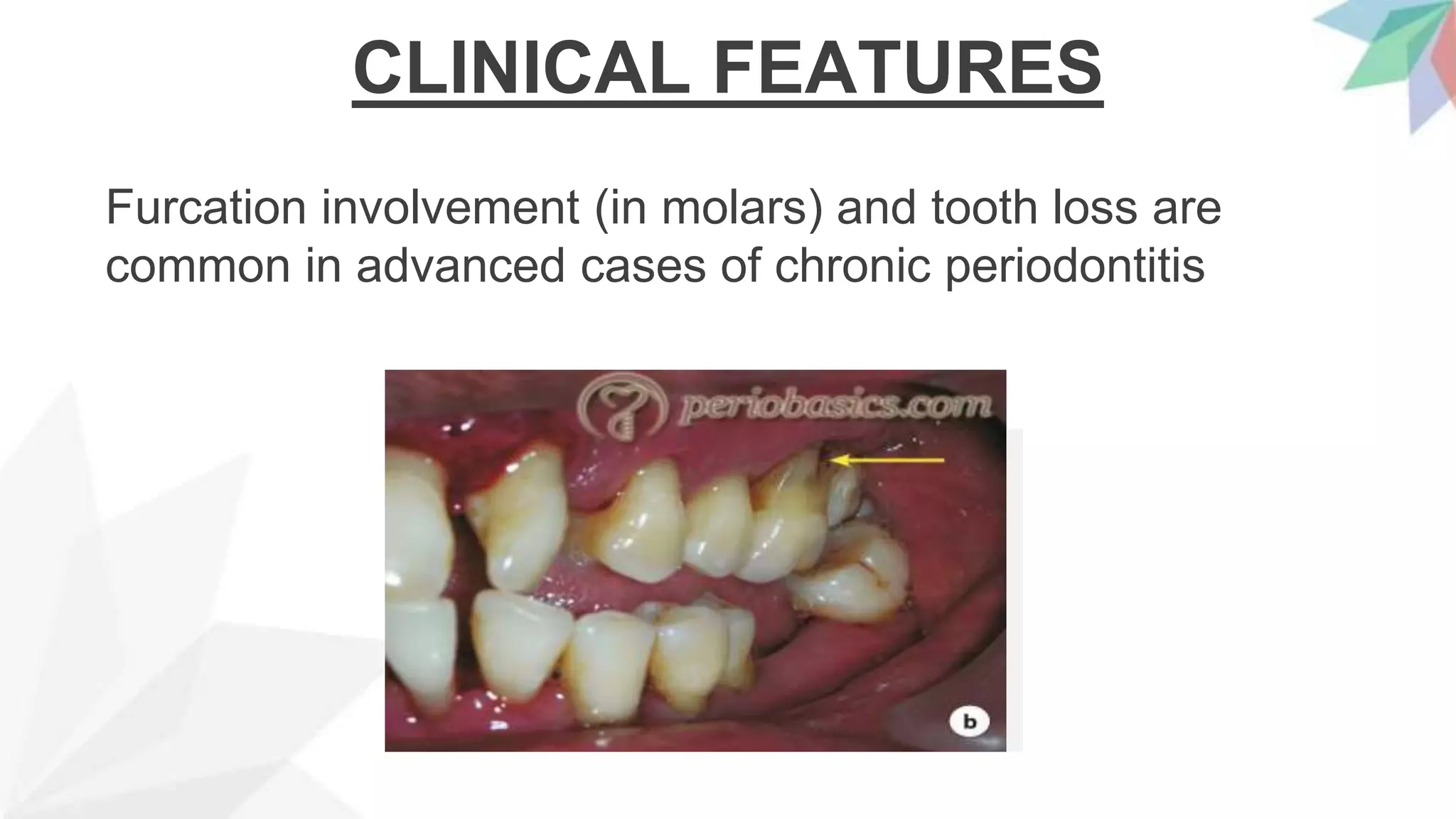 Chronic periodontitis | PPTX