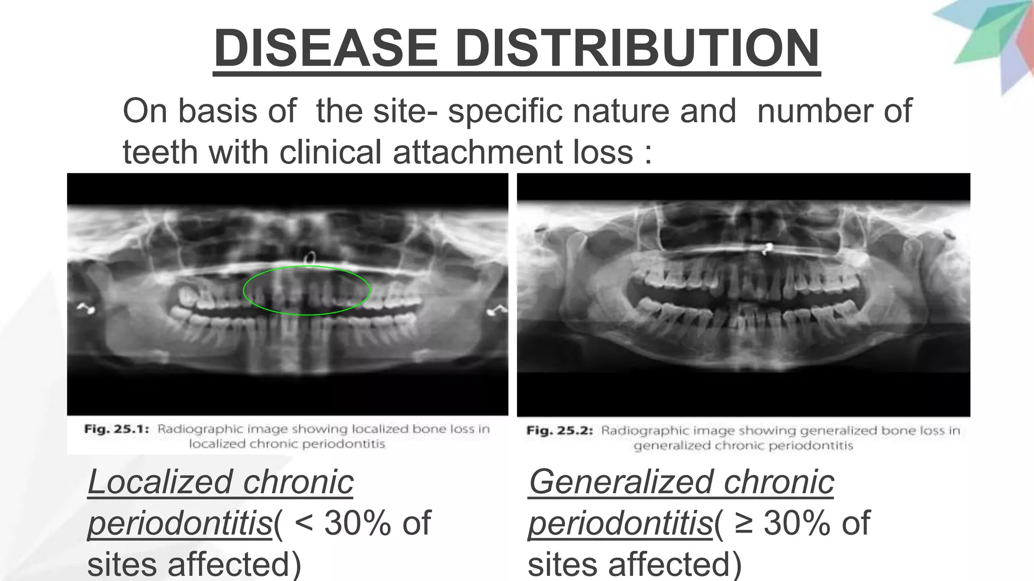 Chronic periodontitis | PPTX