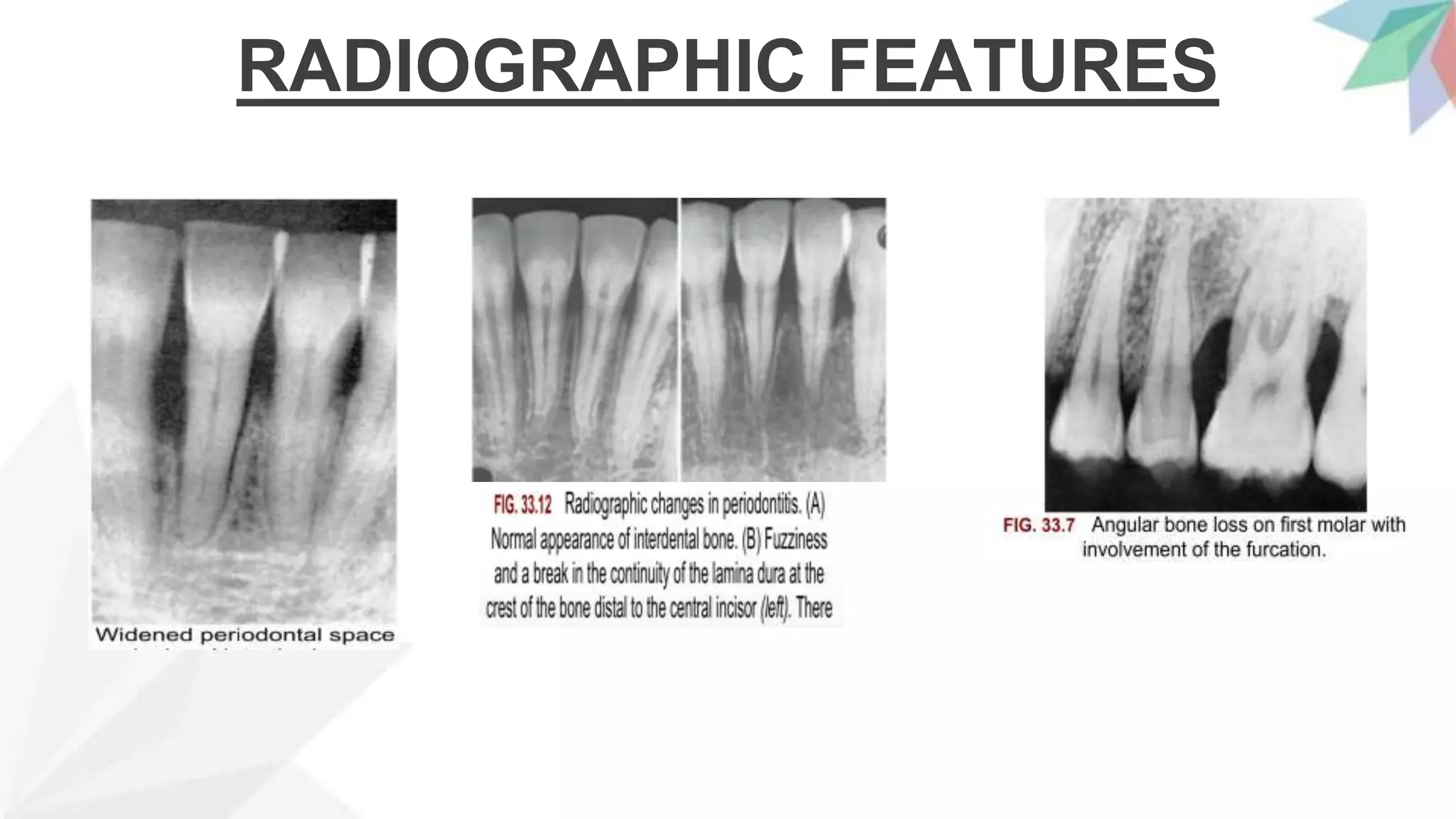 Chronic periodontitis | PPTX