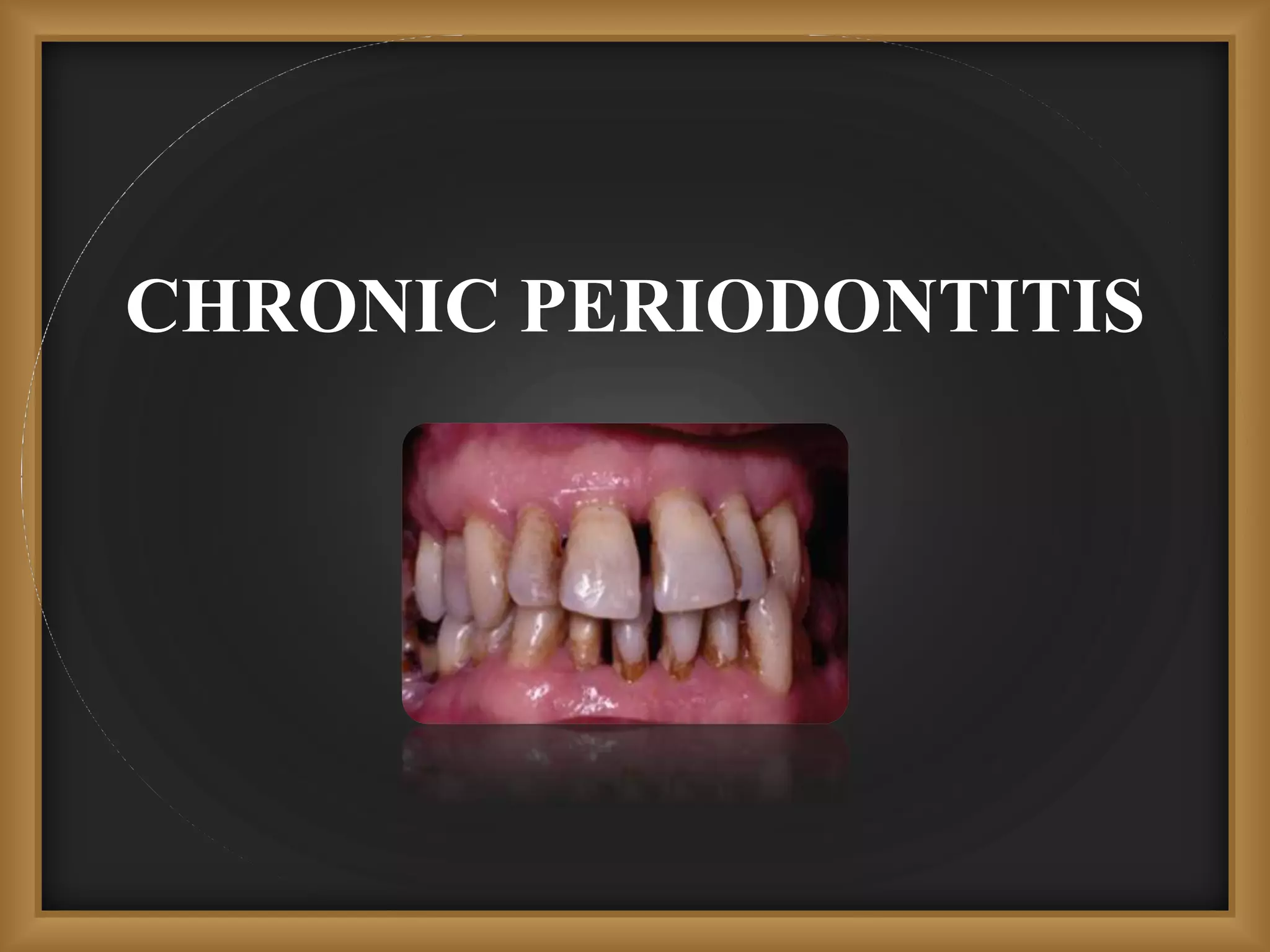 chronic periodontitis.pptx
