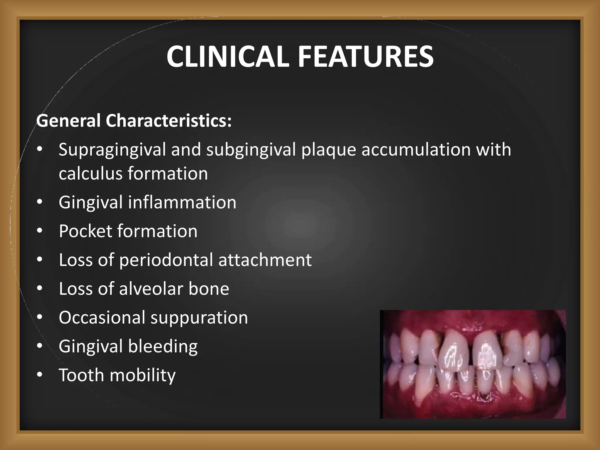 chronic periodontitis.pptx