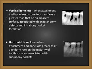 chronic periodontitis.pptx