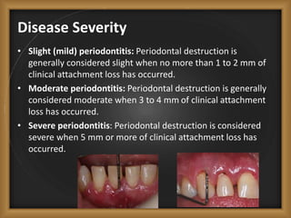chronic periodontitis.pptx