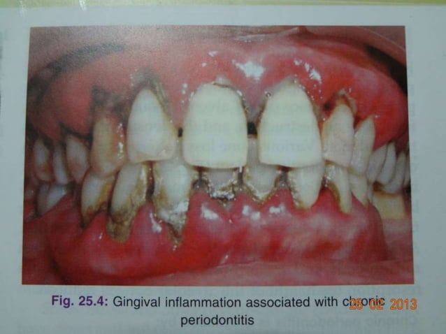 chronic periodontitis.pptx