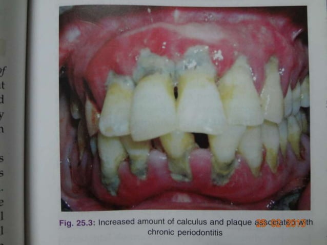 chronic periodontitis.pptx
