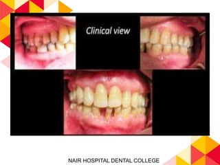 chronic PERIODONTITIS definition and pathophysiology | PPTX