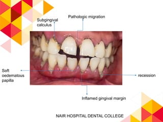 chronic PERIODONTITIS definition and pathophysiology | PPTX