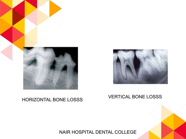 chronic PERIODONTITIS definition and pathophysiology | PPTX