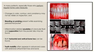 Chronic periodontitis-clinical features and risk factors | PPTX