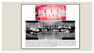 Chronic periodontitis-clinical features and risk factors | PPTX