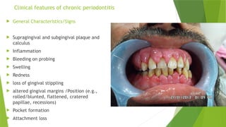 Chronic Periodontitis and associated risk factors | PPT