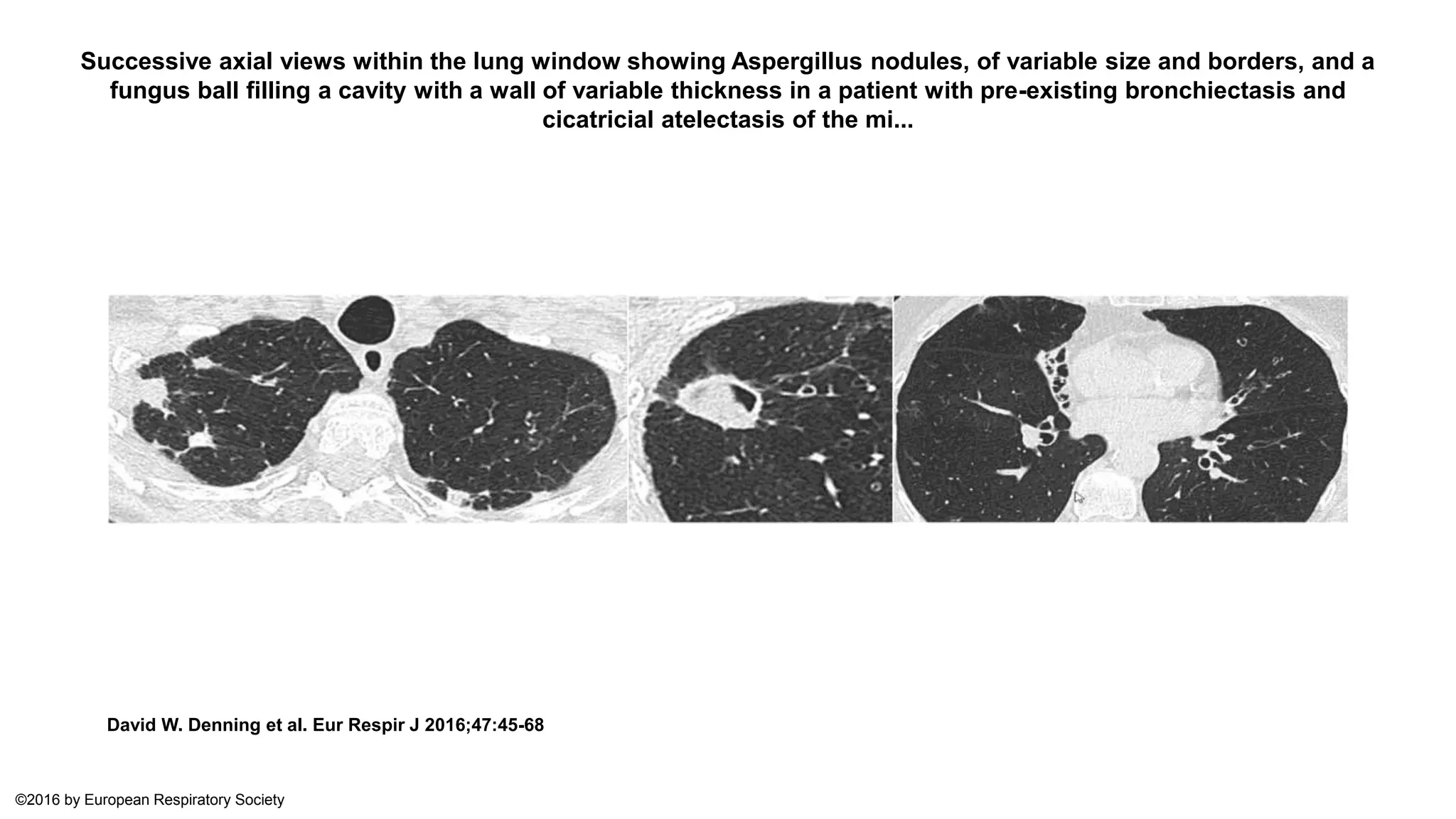 Presentation on Chronic Pulmonary Aspergillosis | PPTX
