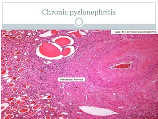 Chronic pyelonephritis | PPTX