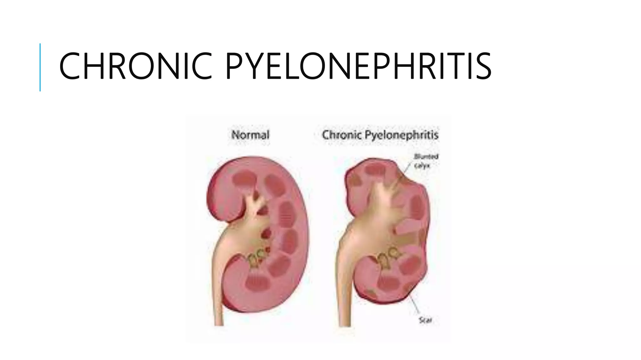 Chronic pyelonephritis, urolithiasis, kidney amyloidosis | PPT