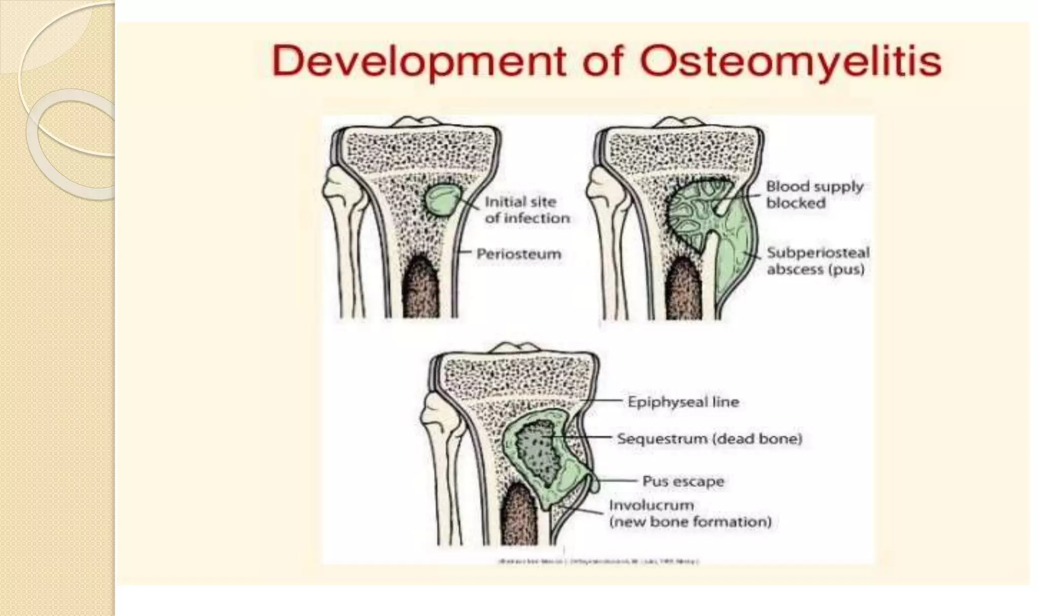 Chronic pyogenic osteomyelitis | PPTX | Bone and Joint Conditions ...