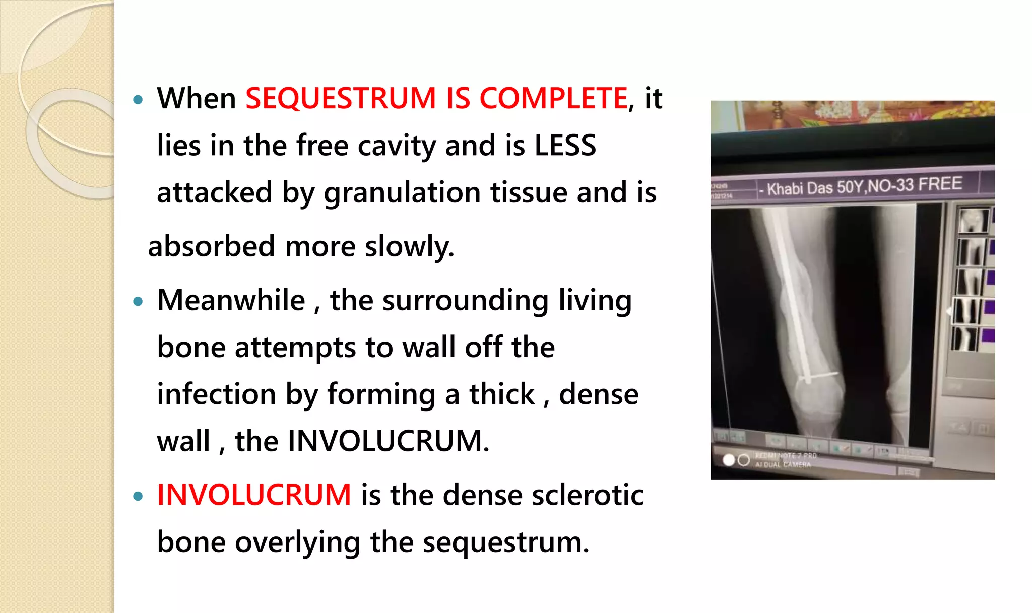 Chronic pyogenic osteomyelitis | PPTX