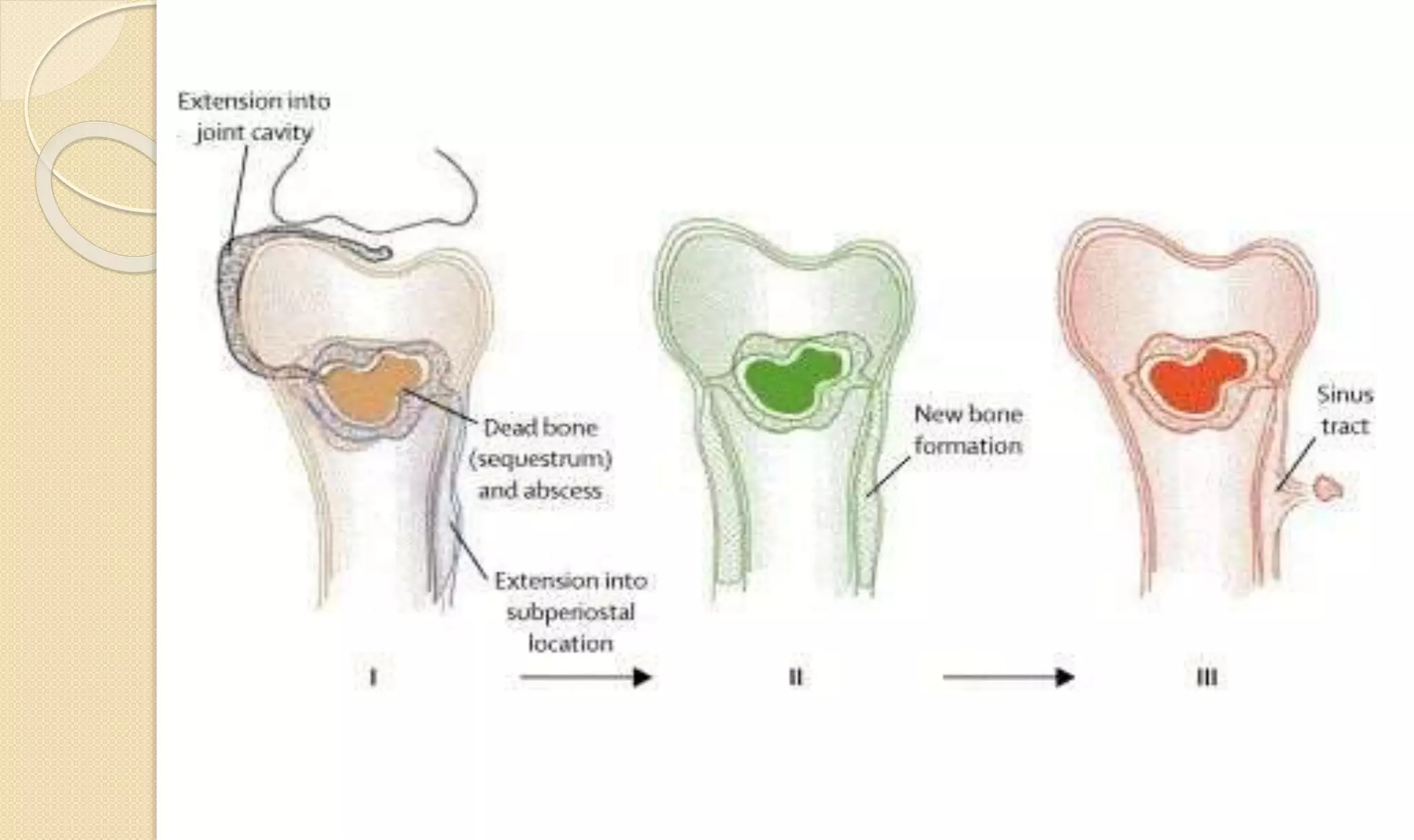 Chronic pyogenic osteomyelitis | PPTX