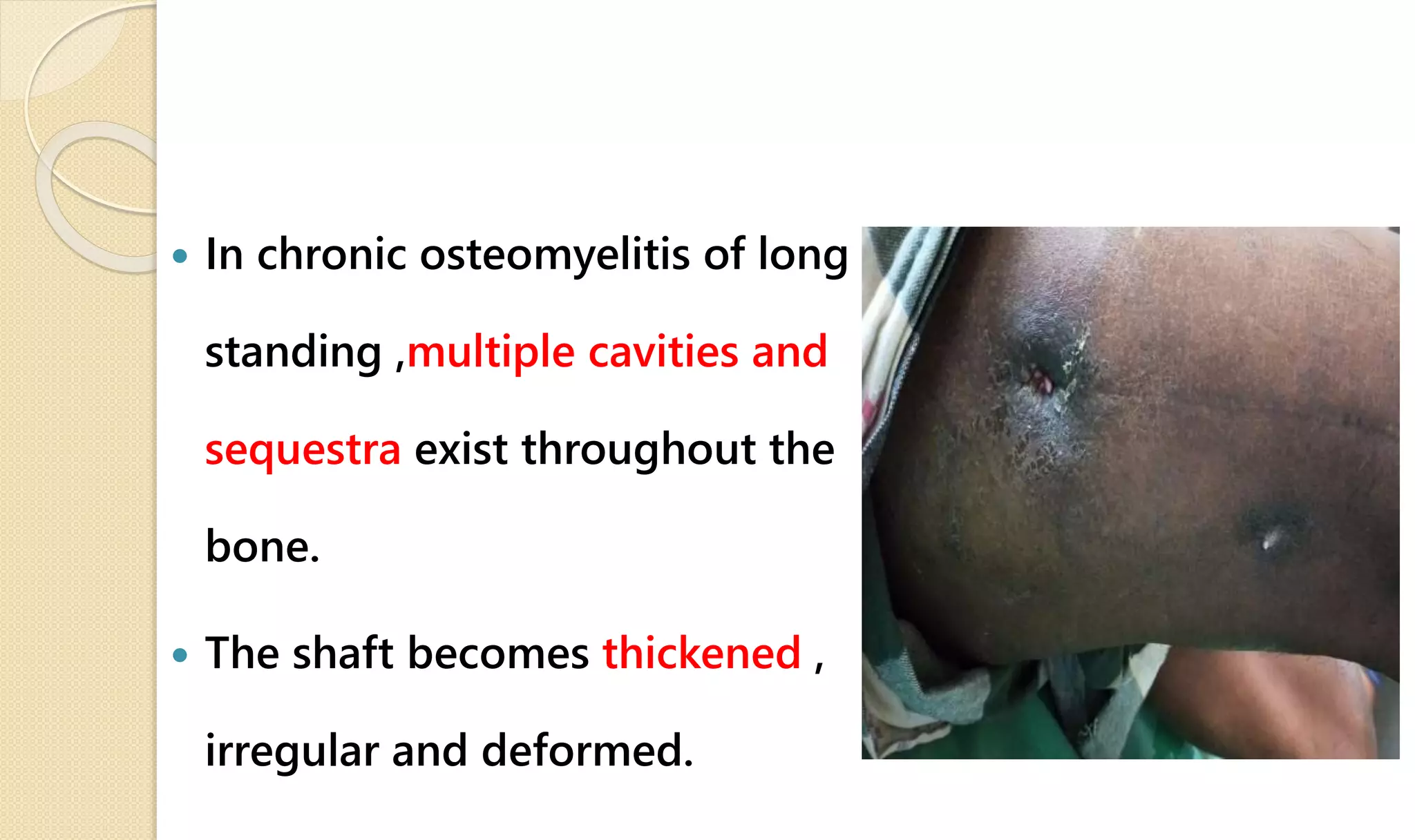 Chronic pyogenic osteomyelitis | PPTX
