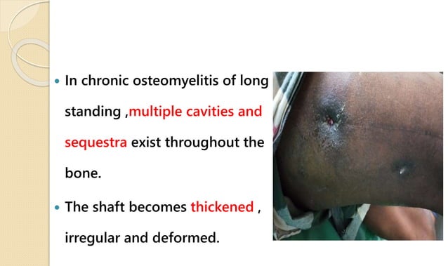 Chronic pyogenic osteomyelitis | PPTX | Bone and Joint Conditions ...