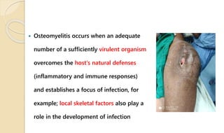 Chronic pyogenic osteomyelitis | PPTX