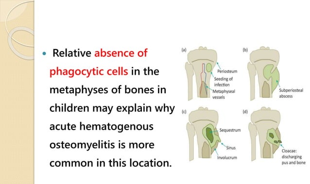 Chronic pyogenic osteomyelitis | PPTX | Bone and Joint Conditions ...