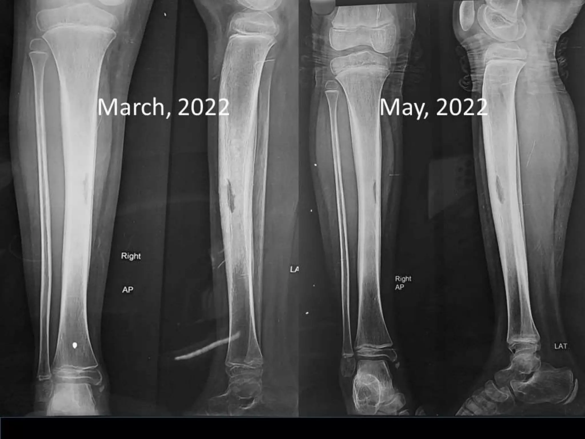 Chronic Recurrent Multifocal Osteomyelitis - a care report.pptx