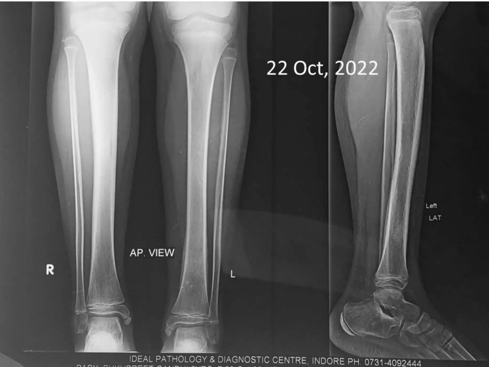 Chronic Recurrent Multifocal Osteomyelitis - a care report.pptx