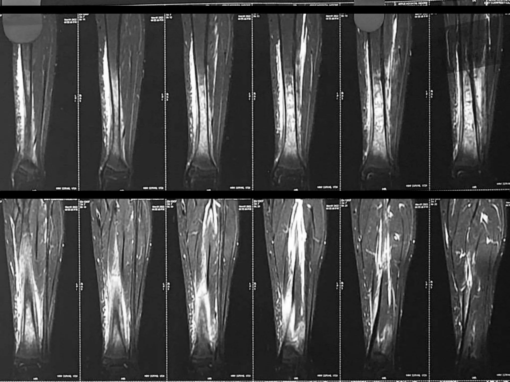 Chronic Recurrent Multifocal Osteomyelitis - a care report.pptx