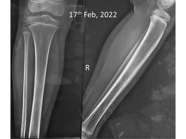 Chronic Recurrent Multifocal Osteomyelitis - a care report.pptx