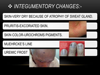 Uremic Frost On Skin