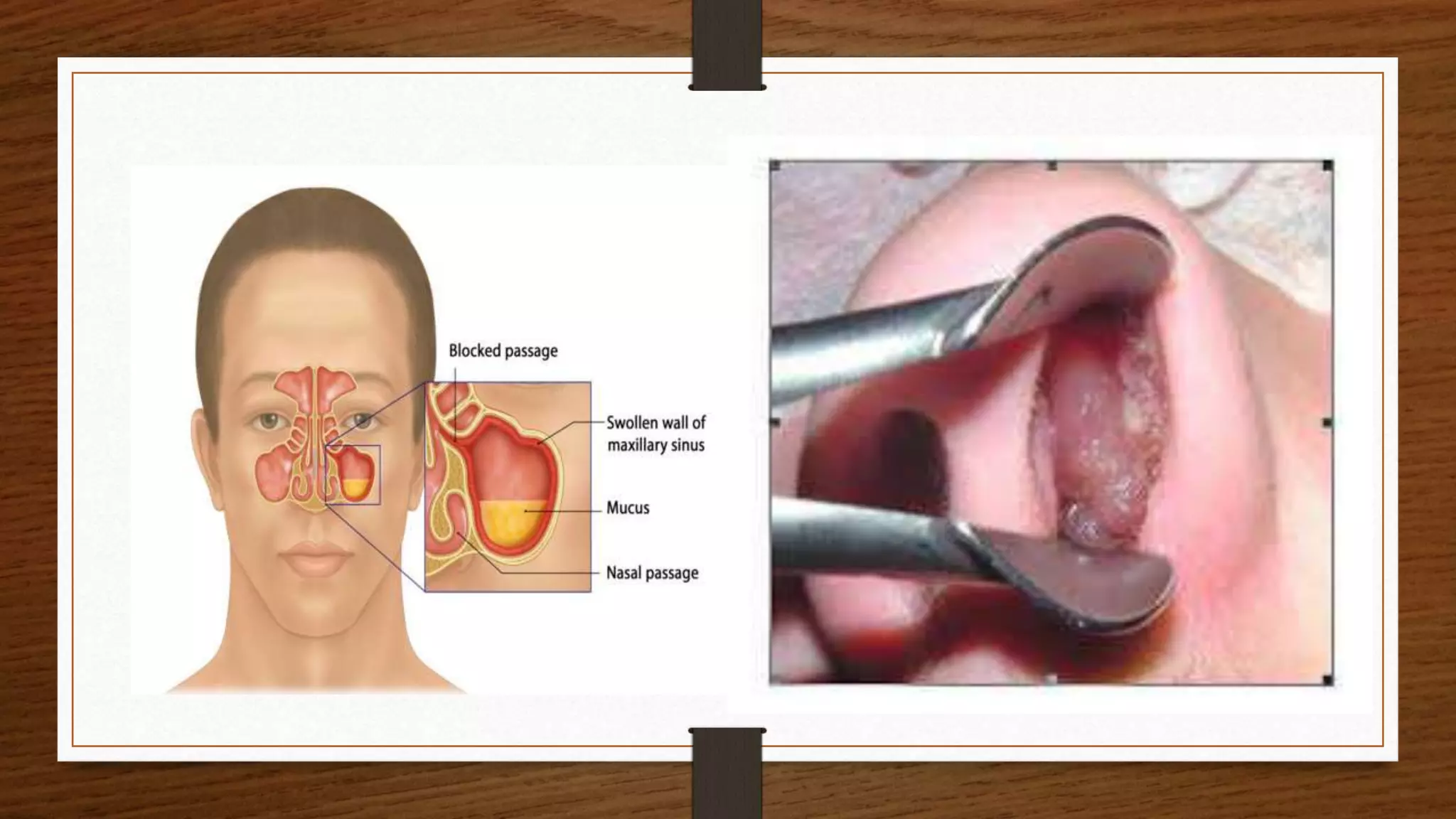 CHRONIC RHINOSINUSITIS.pptx