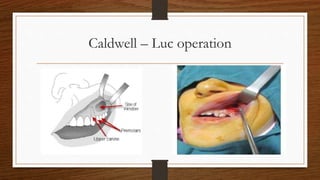 CHRONIC RHINOSINUSITIS.pptx