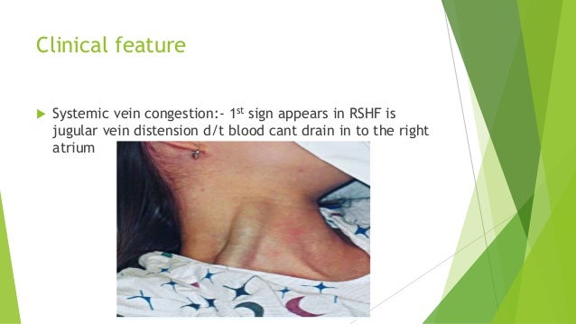 Congestive right heart failure