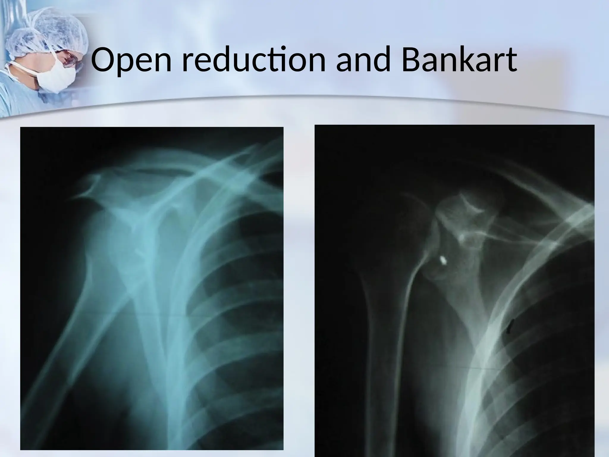 Chronic shoulder dislocation, bedru2020.pptx