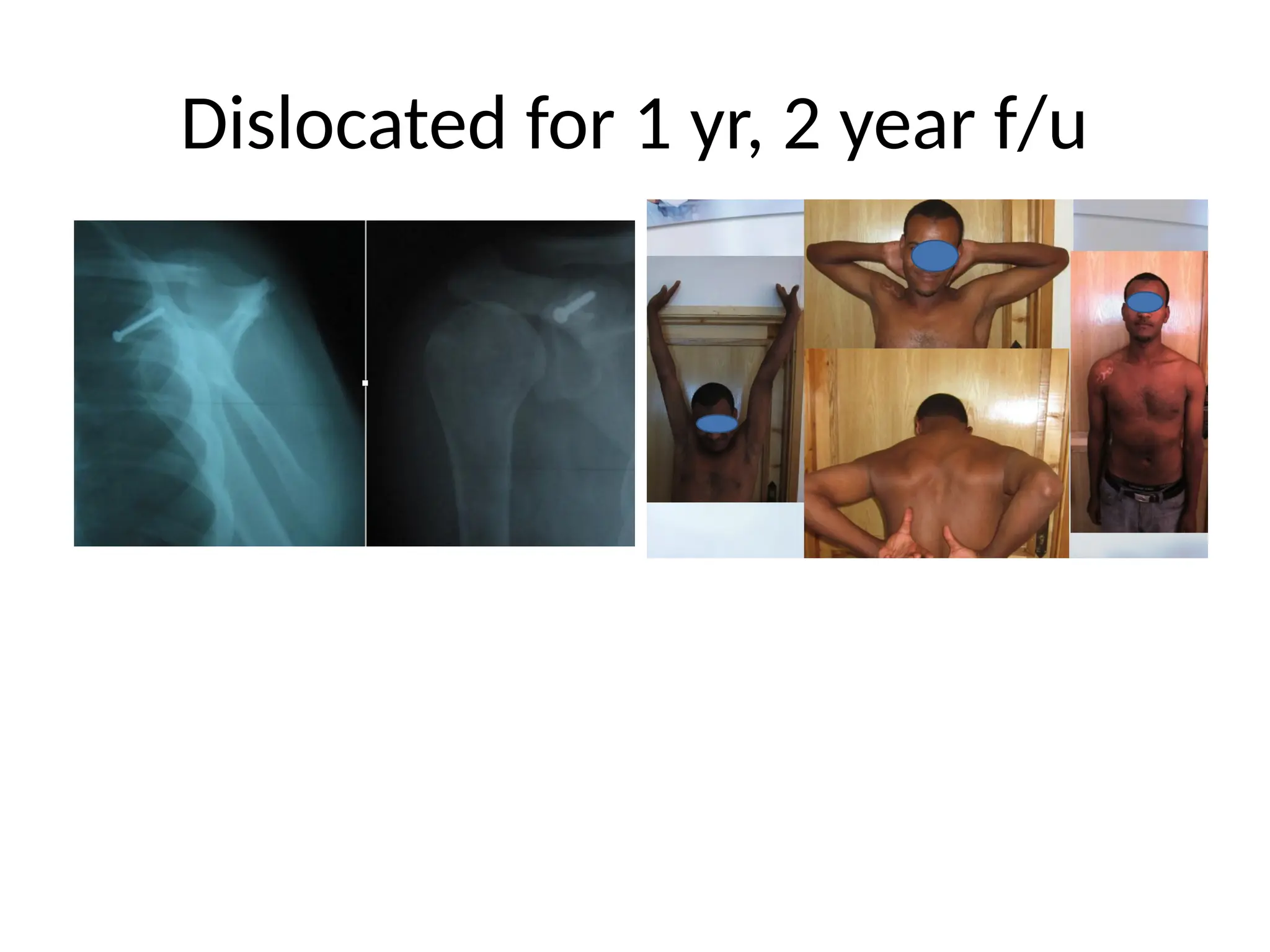Chronic shoulder dislocation, bedru2020.pptx