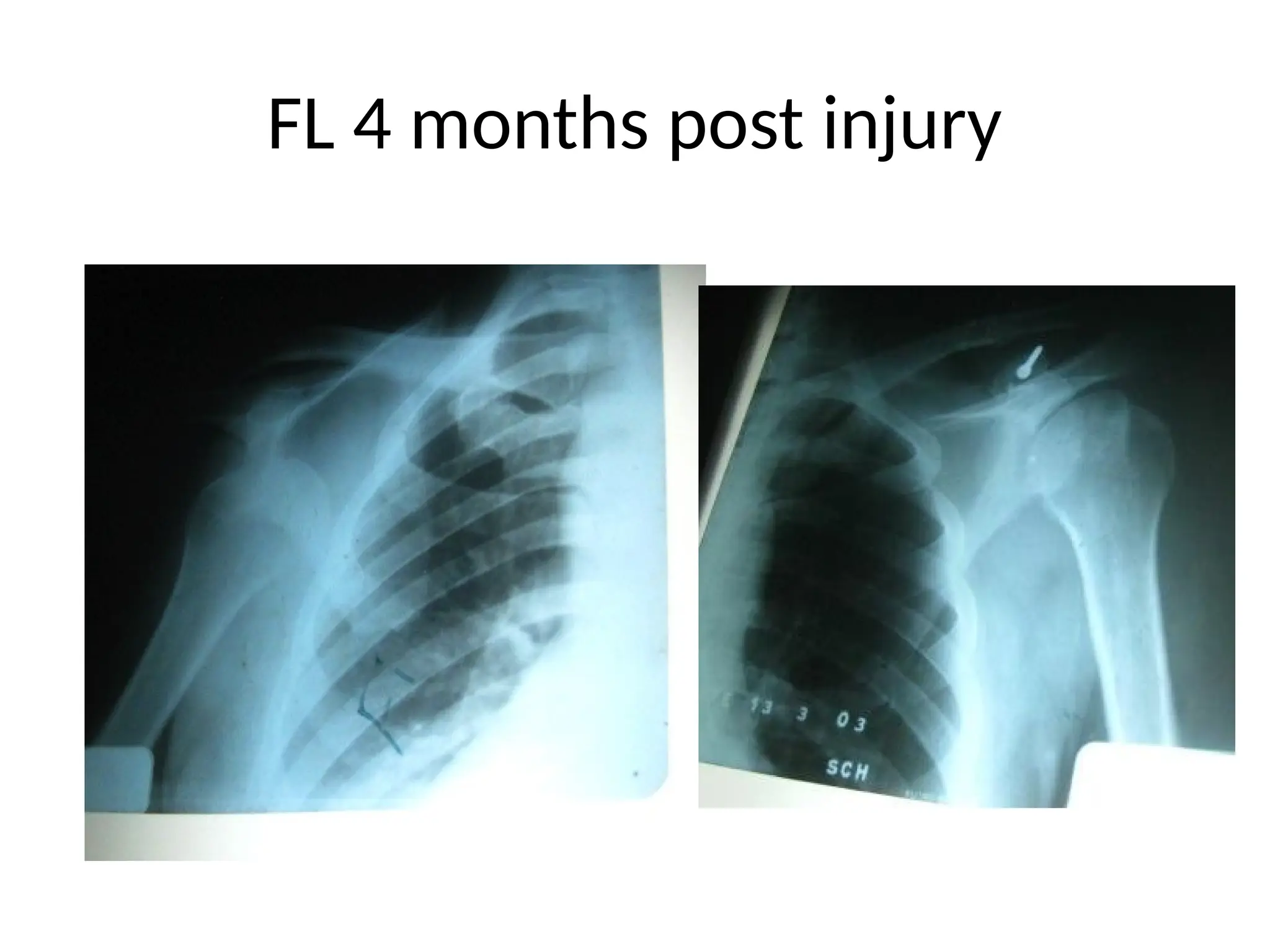 Chronic shoulder dislocation, bedru2020.pptx