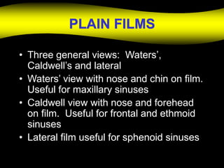 Chronic sinusitis.ppt