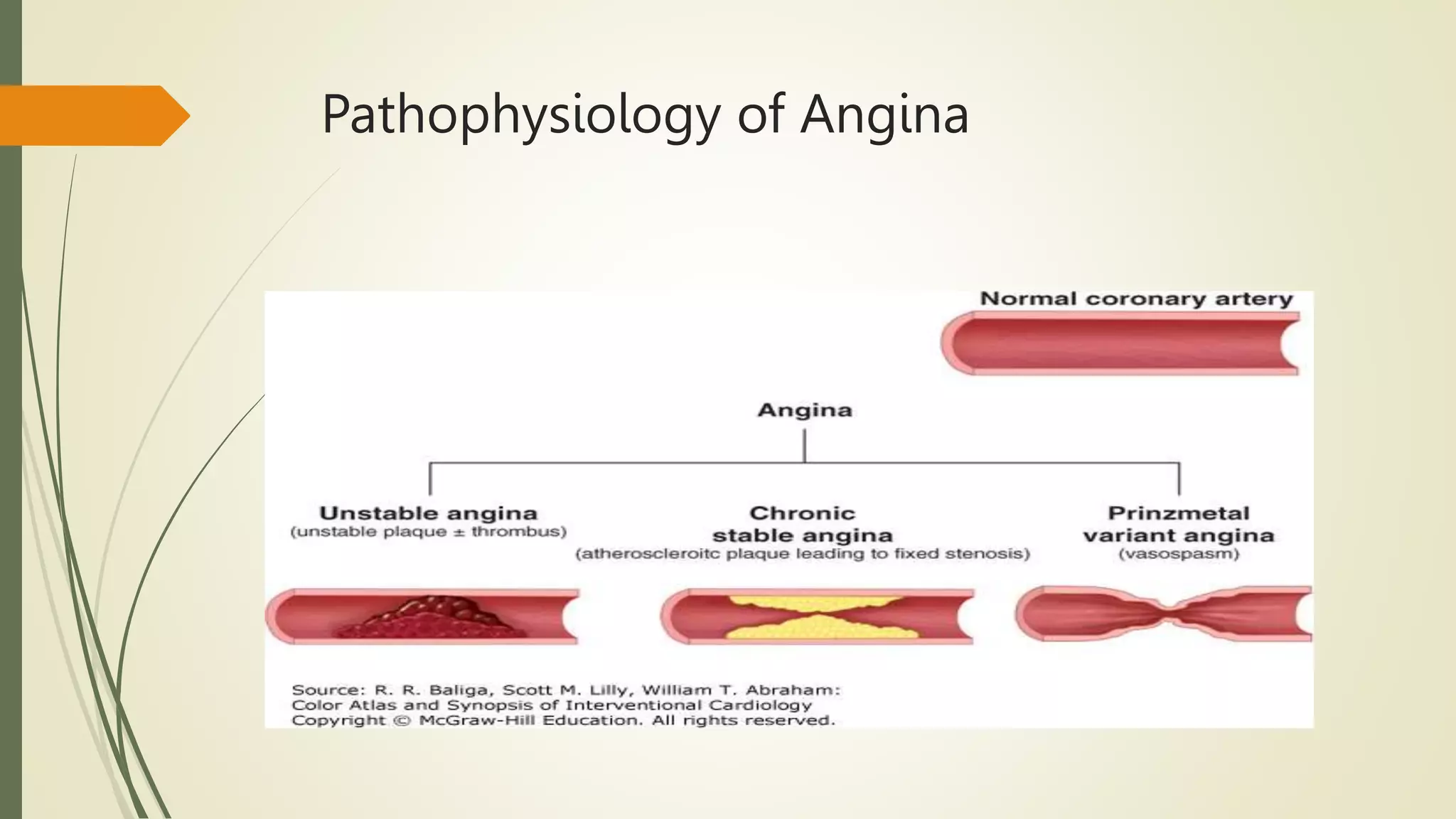 Chronic Stable Angina.pptx