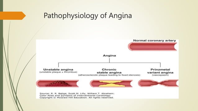 Chronic Stable Angina.pptx