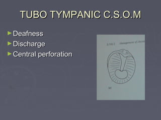 Chronic suppurative otitis media | PPT