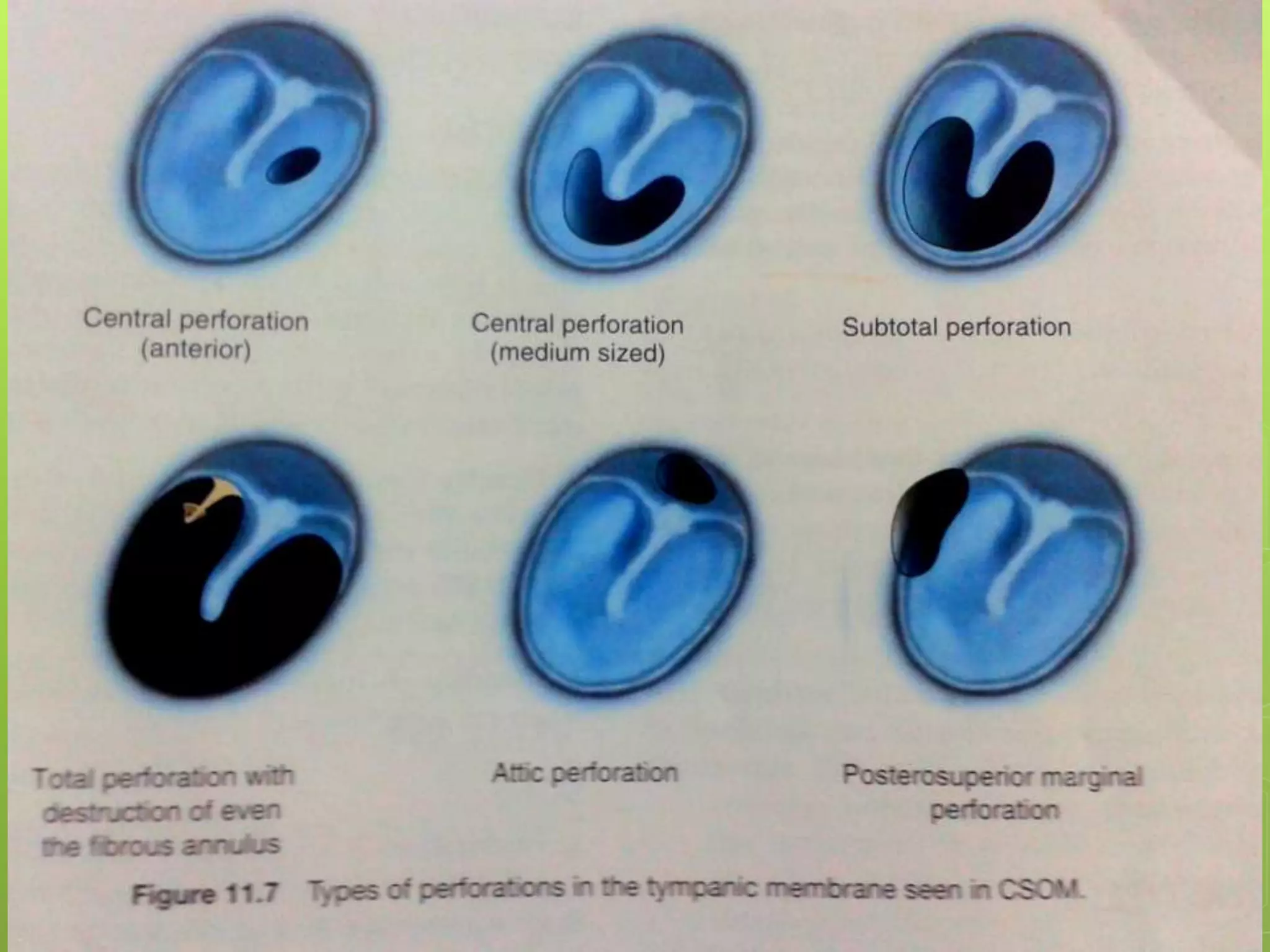 Chronic suppurative otitis media | PPTX