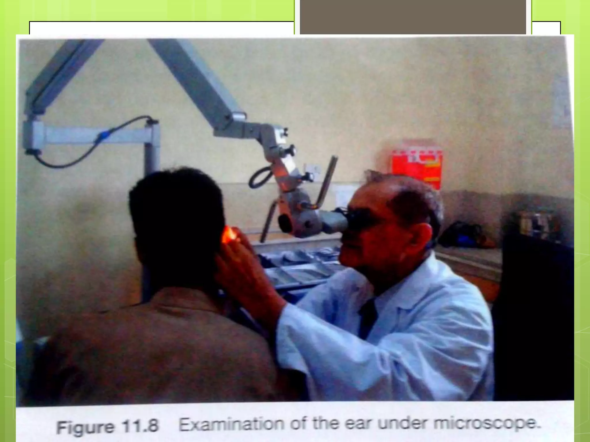 Chronic suppurative otitis media | PPTX